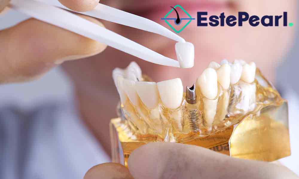What is Prosthetic (Prosthesis) Dentistry - Este Pearl
